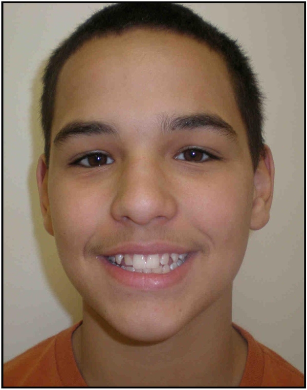 Smile Gallery | Azizi Orthodontics - Ambler & Glenside, PA